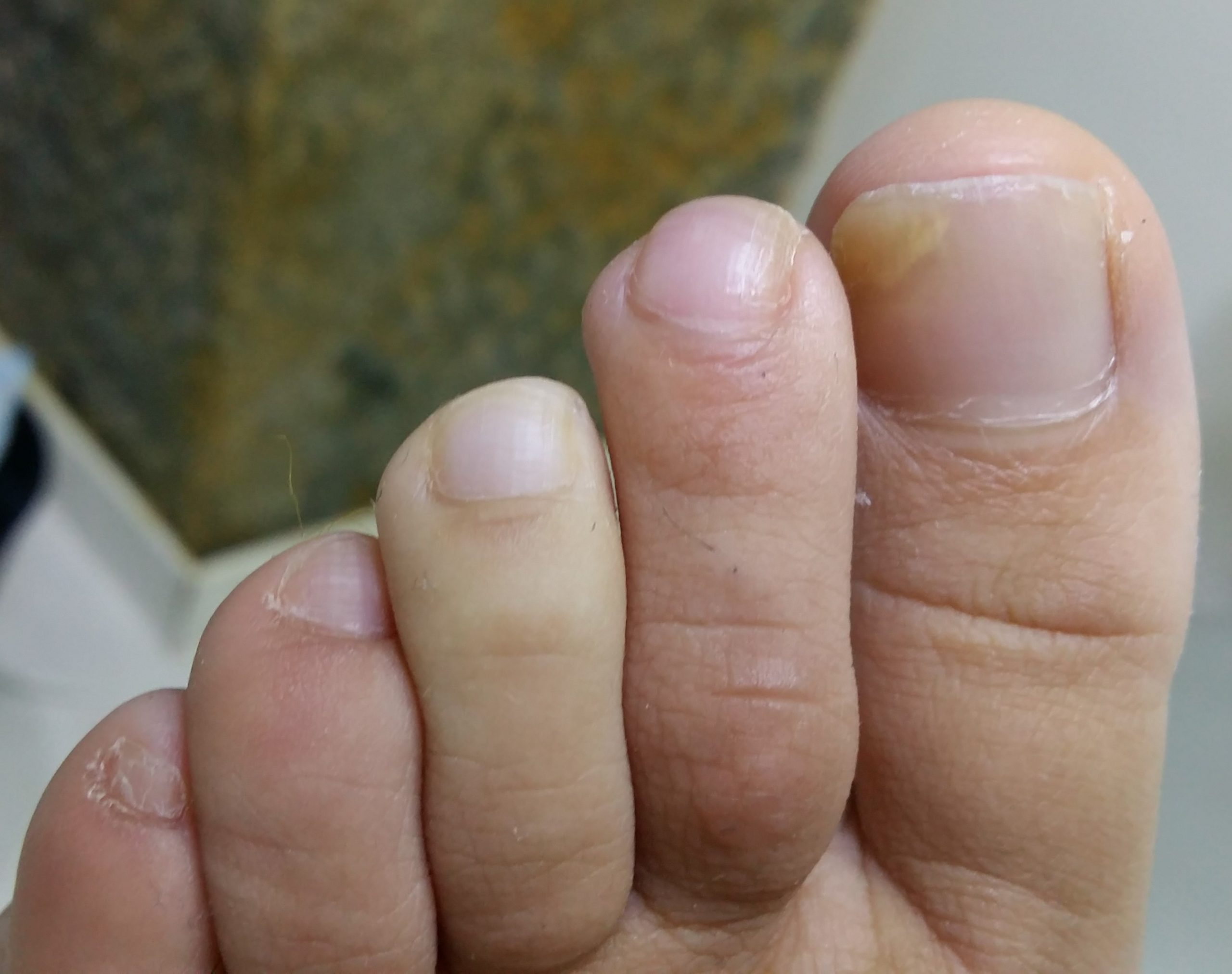 Patologías mas comunes en los pies después del verano